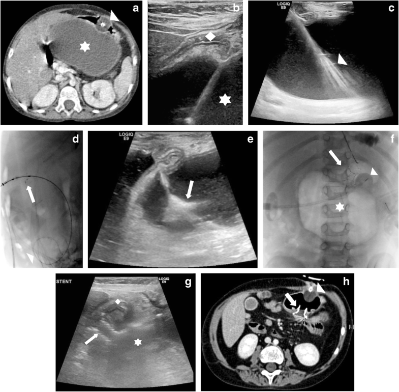 Pancreatic pseudocyst drainage in children by image-guided ...