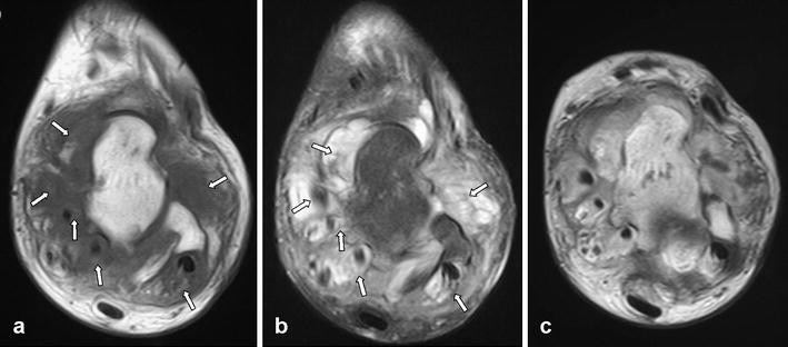 Tenosynovial lipoma arborescens of the ankle in a child | SpringerLink
