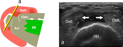 Imaging findings of spontaneous detachment of the deltoid muscle as a ...