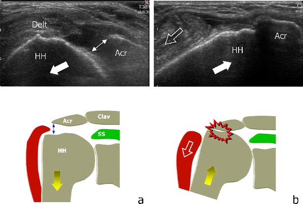 Imaging findings of spontaneous detachment of the deltoid muscle as a ...