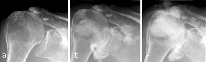 Imaging findings of spontaneous detachment of the deltoid muscle as a ...