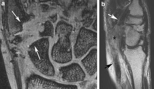 Flexor carpi radialis tendinopathy: spectrum of imaging findings and ...