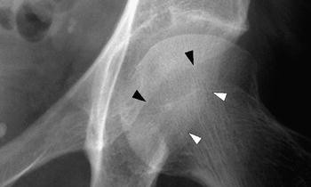 Acetabular retroversion as a rare cause of chronic hip pain ...