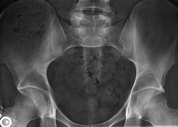 Acetabular retroversion as a rare cause of chronic hip pain ...