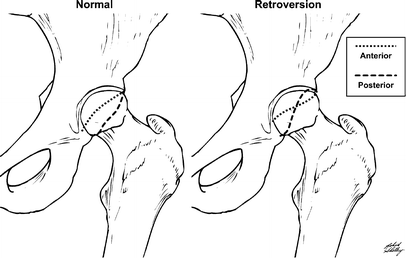 Acetabular retroversion as a rare cause of chronic hip pain ...