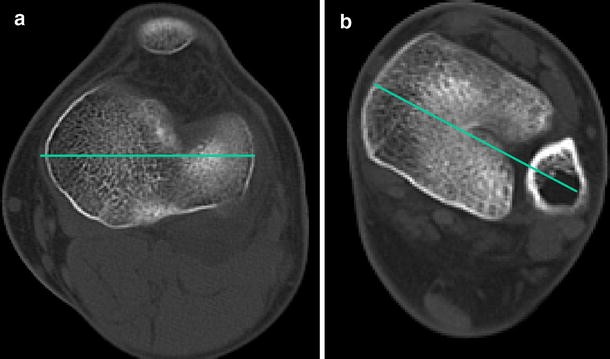 Rotational profile of the lower extremity in achondroplasia: computed ...