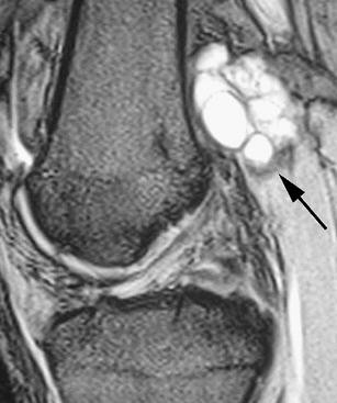 Ganglion cysts at the gastrocnemius origin: a series of ten cases ...
