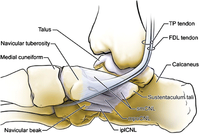 Sonography of the superomedial part of the spring ligament complex of the foot: a study of ...