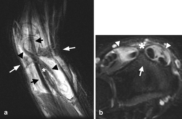 Distal intersection tenosynovitis of the wrist: a lesser-known extensor ...