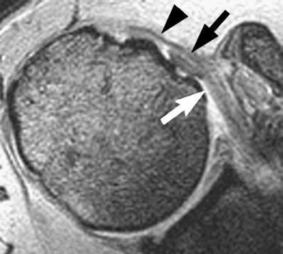 MR imaging of delamination tears of the rotator cuff tendons | SpringerLink