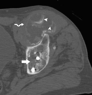 The imaging appearances of metallosis | SpringerLink