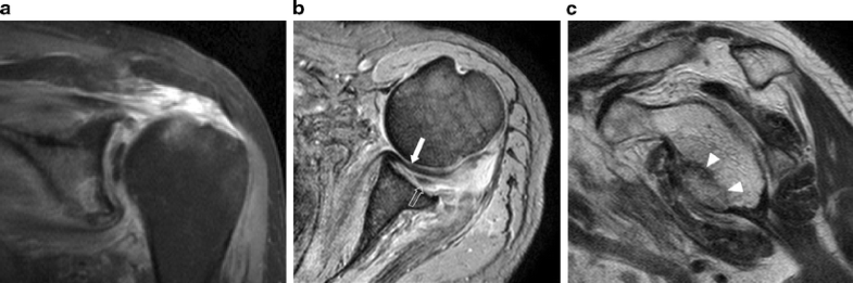 Irreducible anterior dislocation of the shoulder due to soft tissue ...