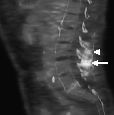 Baastrup’s disease (kissing spine) demonstrated by FDG PET/CT ...
