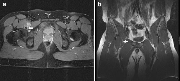 Iliopsoas injury: an MRI study of patterns and prevalence correlated ...