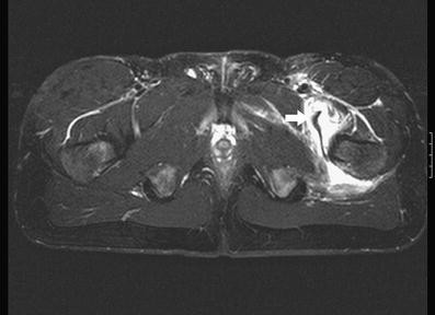 Iliopsoas injury: an MRI study of patterns and prevalence correlated ...