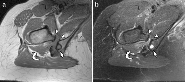 Impingement of lesser trochanter on ischium as a potential cause for ...