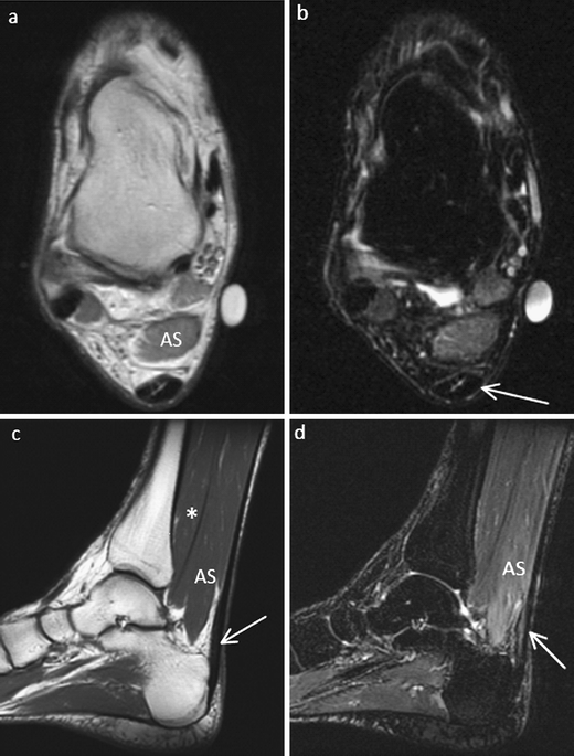 High association between accessory soleus muscle and Achilles ...