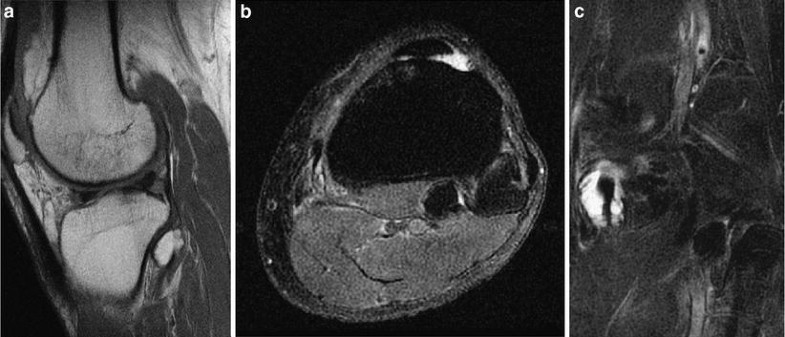 MR features of a giant cyamella in a patient with osteoarthritis ...