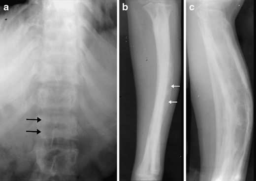 Camurati–Engelmann disease: imaging, clinical features and differential ...