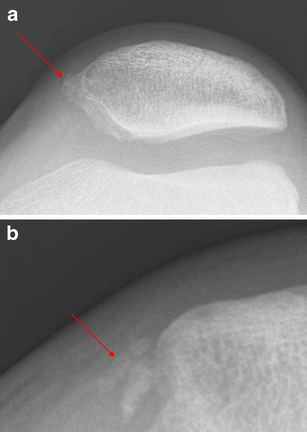 Medial patellar ossification after patellar instability: a radiographic ...