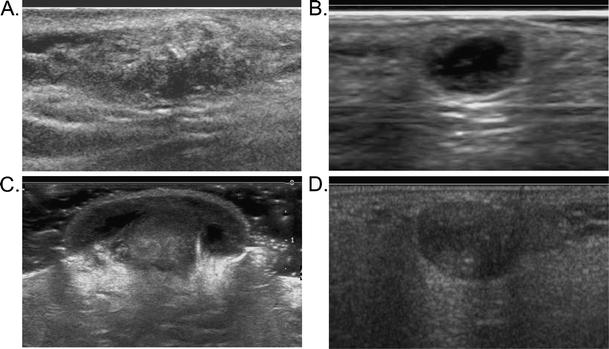 Pilomatricomas: the diagnostic value of ultrasound | SpringerLink