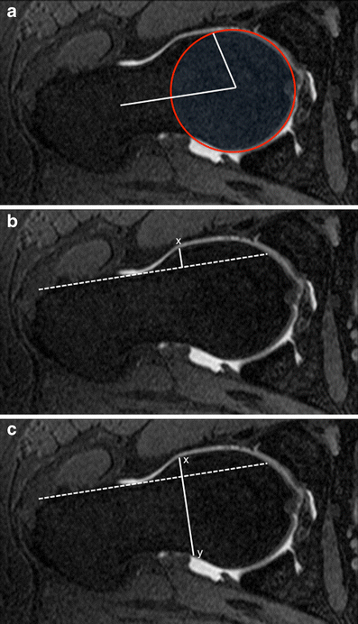 Cam-type femoral-acetabular impingement: is the alpha angle the best MR ...