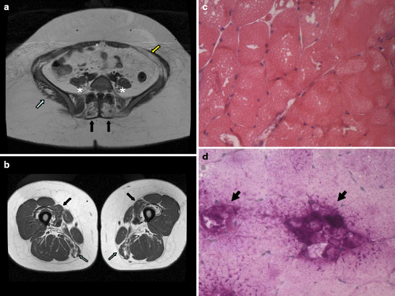 Adult onset glycogen storage disease type II (adult onset Pompe disease ...