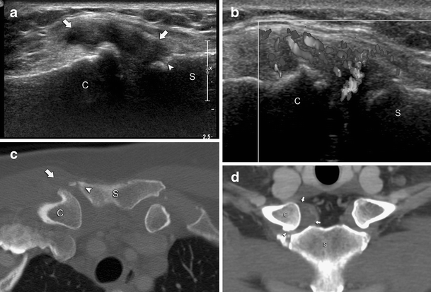 The sternoclavicular joint: can imaging differentiate infection from ...
