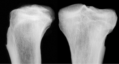 Proximal tibial osteophytes and their relationship with the height of ...