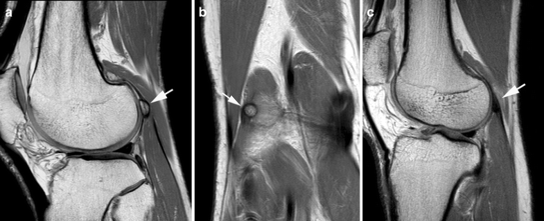 Magnetic resonance imaging of anatomical variations in the knee ...