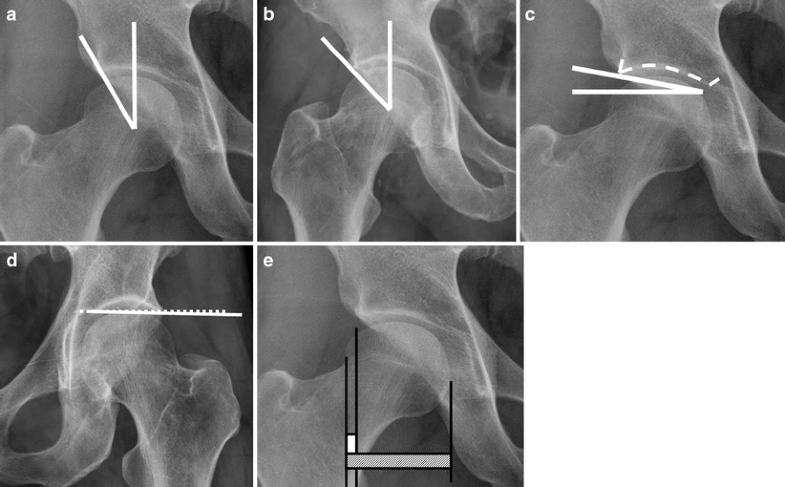 Herniation pits in the femoral neck: a radiographic indicator of ...