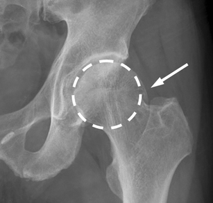 Herniation pits in the femoral neck: a radiographic indicator of ...