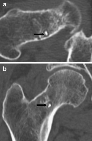 Bony sequestrum: a radiologic review | SpringerLink