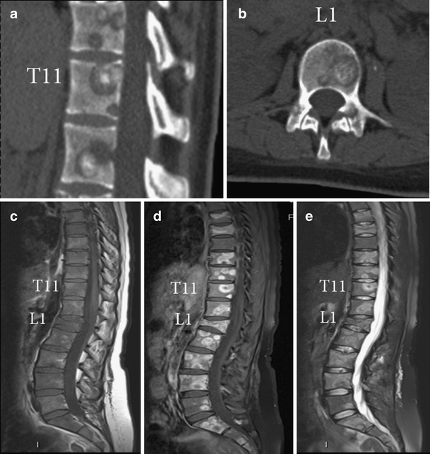 Bony sequestrum: a radiologic review | SpringerLink