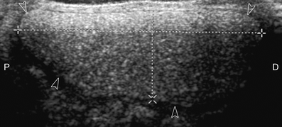 Ultrasound features of tophi in chronic tophaceous gout | SpringerLink
