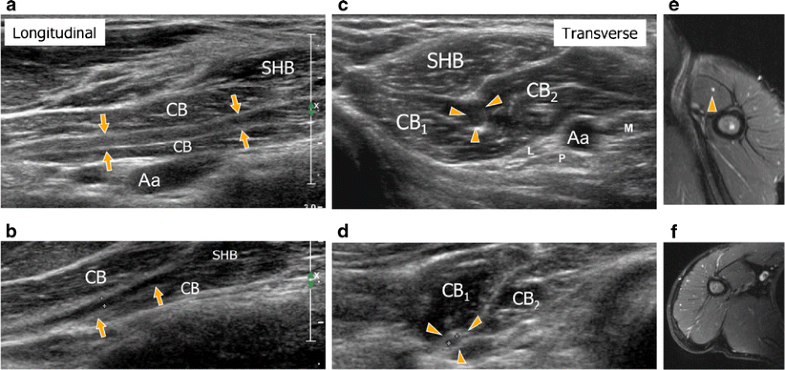 US imaging of the musculocutaneous nerve | SpringerLink