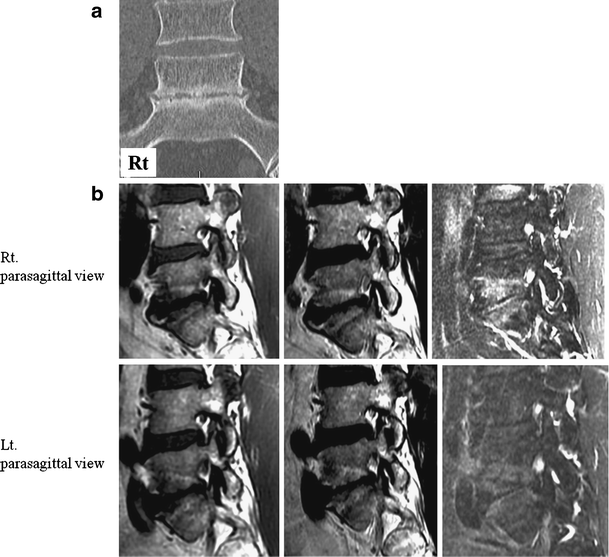 Modic type I changes of the lumbar spine in golfers | SpringerLink