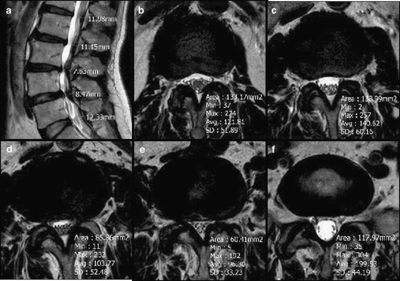 A New Grading System Of Lumbar Central Canal Stenosis On Mri An Easy