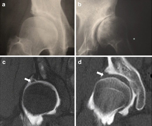 Comparison of MR-arthrography and MDCT-arthrography for detection of ...