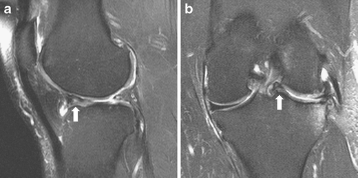 Wrisberg variant of the discoid lateral meniscus with flipped meniscal ...