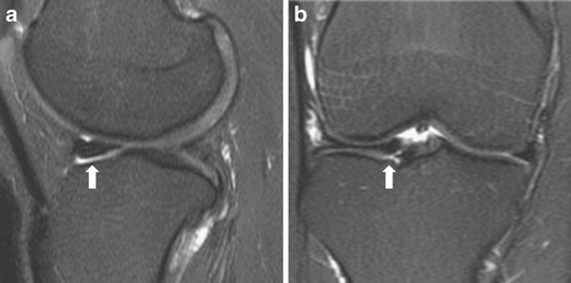 Wrisberg variant of the discoid lateral meniscus with flipped meniscal ...