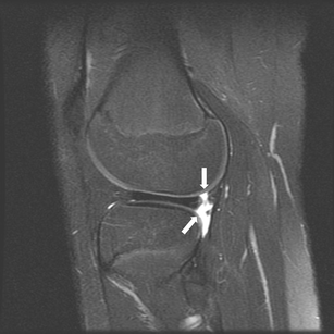 Wrisberg variant of the discoid lateral meniscus with flipped meniscal ...