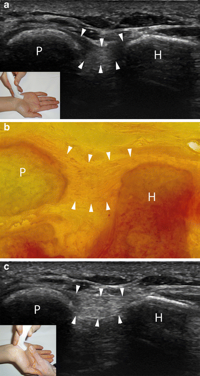 Anatomical study of the pisotriquetral joint ligaments using ...