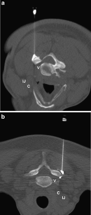 CT-guided cervical nerve root injections: comparing the immediate post ...