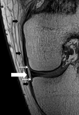 High resolution magnetic resonance imaging of the patellar retinaculum ...
