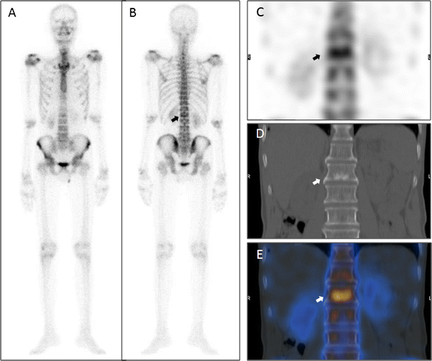 Indeterminate lesions on planar bone scintigraphy in lung cancer ...