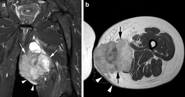 MRI of superficial soft tissue masses: analysis of features useful in ...
