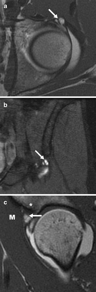 Paralabral cysts in the hip joint: findings at MR arthrography ...