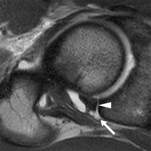 Paralabral cysts in the hip joint: findings at MR arthrography ...