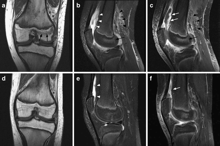 MRI findings of treated bacterial septic arthritis | SpringerLink